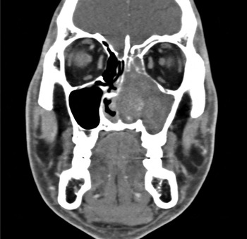 Organised haematoma of the maxillary sinus in patients with chronic ...