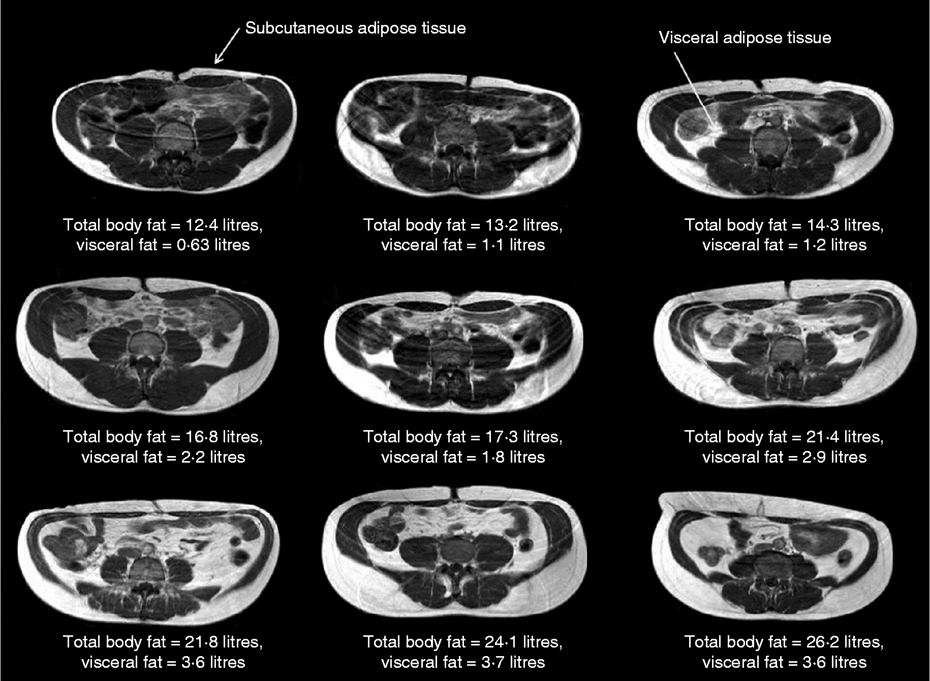 Excess body fat in obese and normal-weight subjects | Nutrition ...