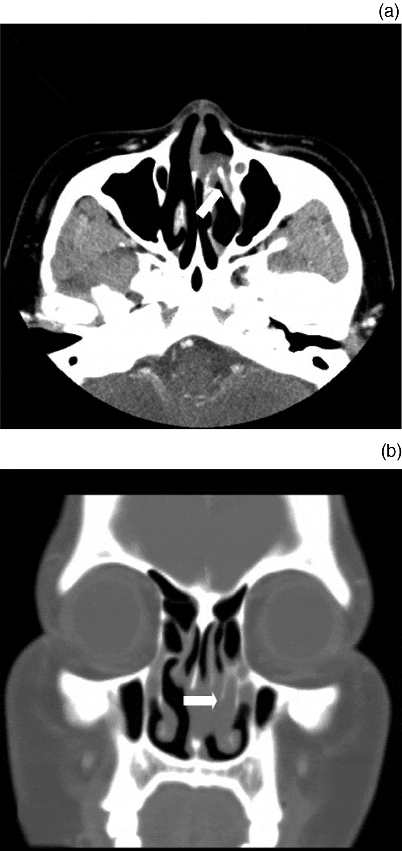 Polyps originating from accessory middle turbinate and secondary middle ...