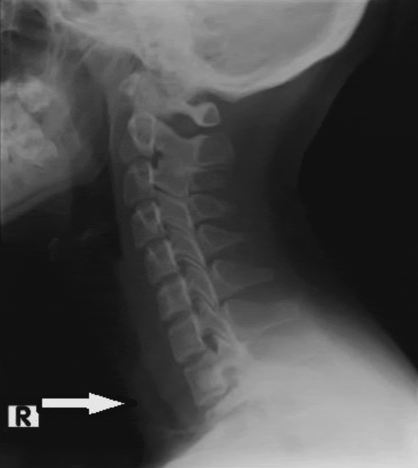 Iatrogenic tracheal flap mimicking tracheal stenosis with resultant ...