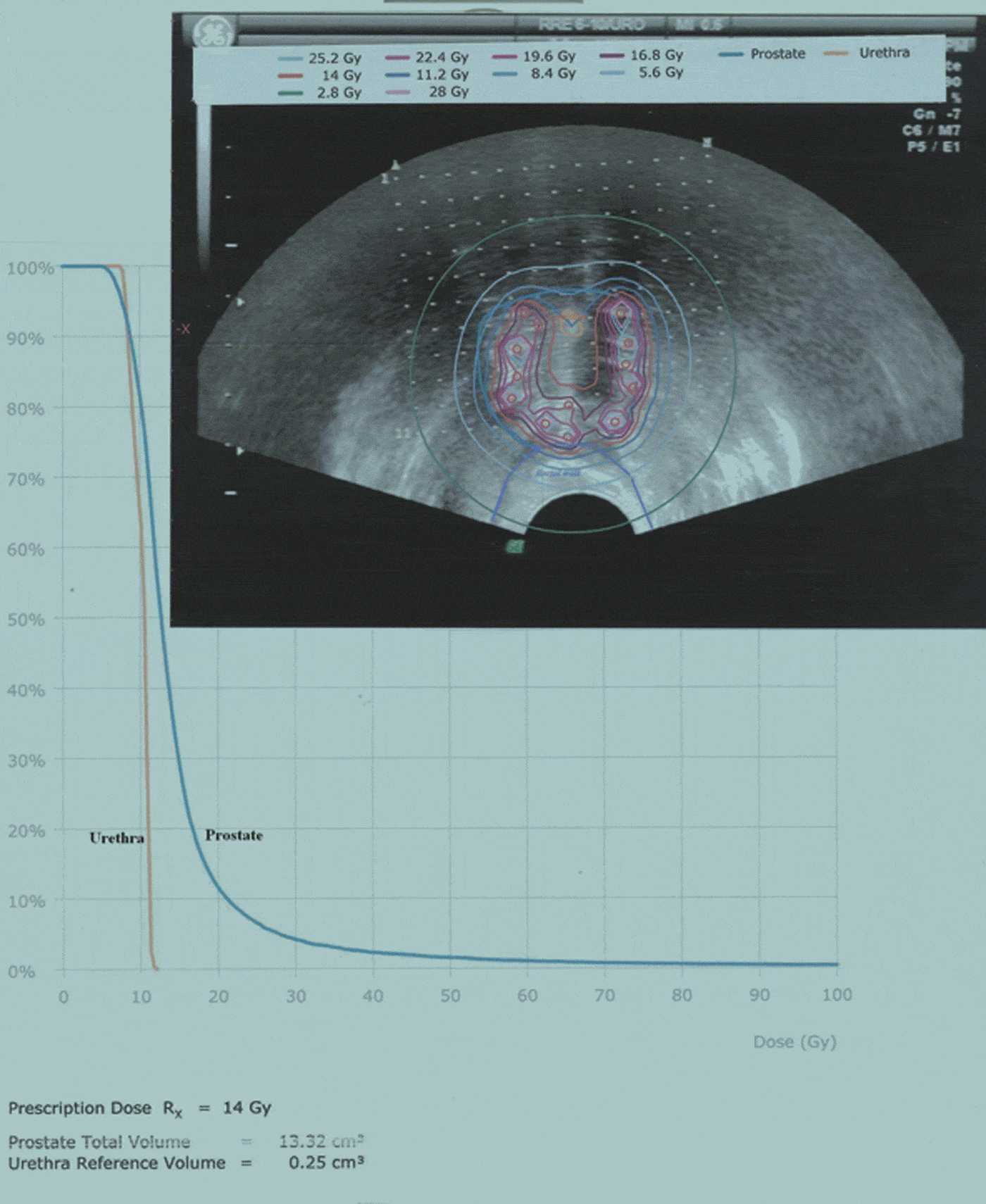 Conformal radiotherapy plus high dose rate brachytherapy prostate boost ...