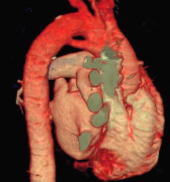 Multi-detector computed tomography demonstration of double-lumen aortic ...