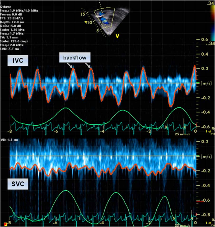 Pulsatile venous waveform quality affects the conduit performance in ...
