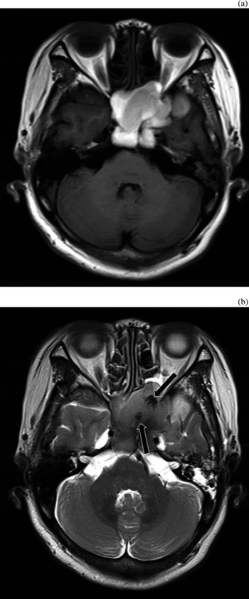 Fungus ball within a mucocele of the sphenoid sinus and infratemporal ...