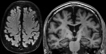Structural MRI | International Psychogeriatrics | Cambridge Core
