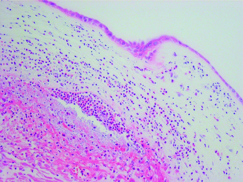 HISTOLOGICAL CHORIOAMNIONITIS: CURRENT CONCEPTS OF DIAGNOSIS ...