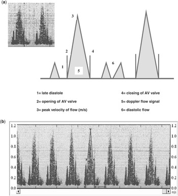 Clinical validation of the non-invasive cardiac output monitor USCOM-1A ...