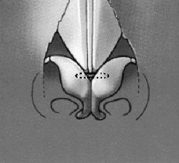 Suture techniques in nasal tip sculpture: current concepts | The ...