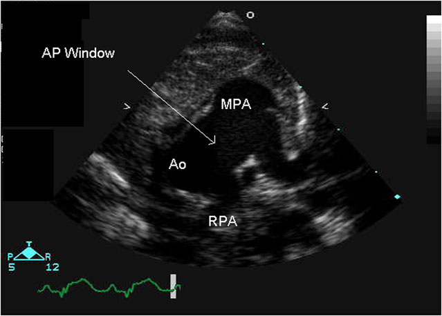Echocardiography of the aortopulmonary window, aorto-ventricular ...