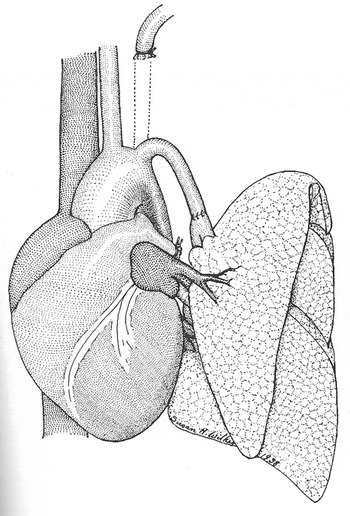 The Blalock-Taussig shunt: the social history of an eponym | Cardiology ...