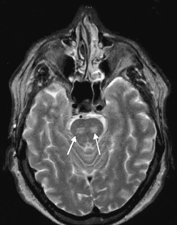 Magnetic resonance imaging findings in a case of stroke-related ...