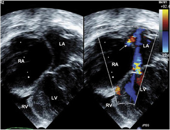 Thrombus in a juxtaposed right atrial appendage | Cardiology in the ...