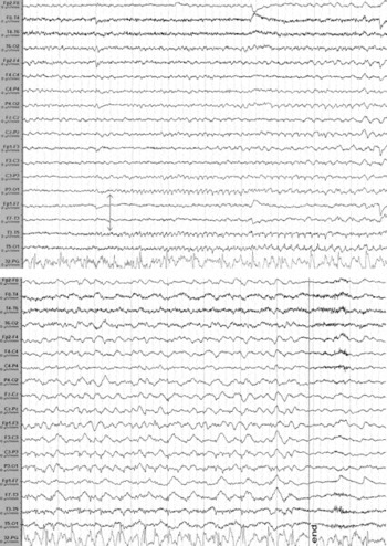 Complex visual hallucinations and occipital seizures | Acta ...