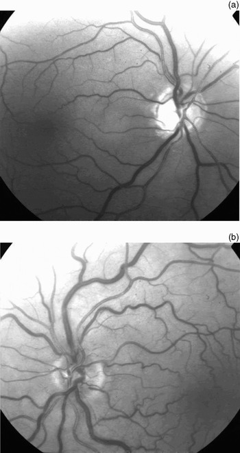 Post-traumatic pulsatile tinnitus: the hallmark of a direct carotico ...