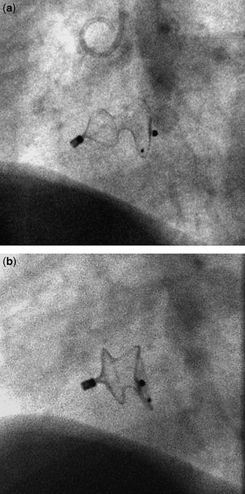 The Amplatzer® Membranous VSD Occluder and the vulnerability of the ...