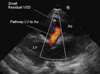 Anatomy, echocardiography, and surgical approach to double outlet right ...