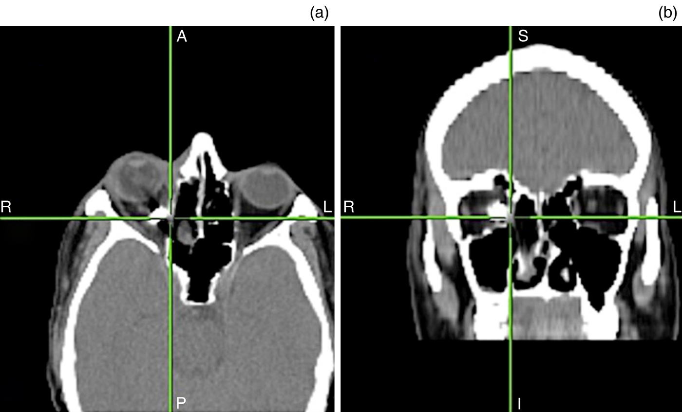Endoscopic transnasal approach to medial orbital lesions | The Journal ...