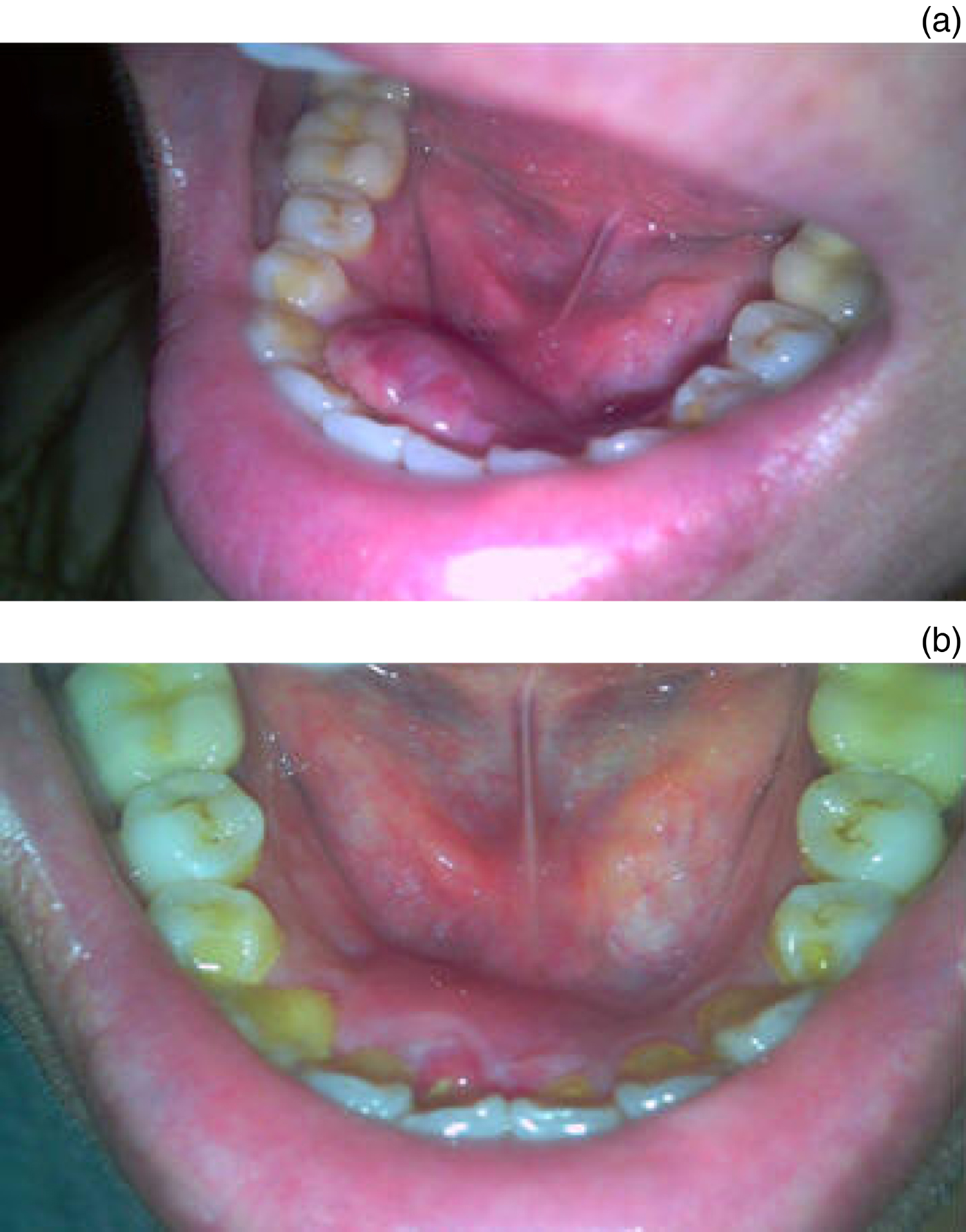 Treatment of pregnancy-associated oral pyogenic granuloma with life ...
