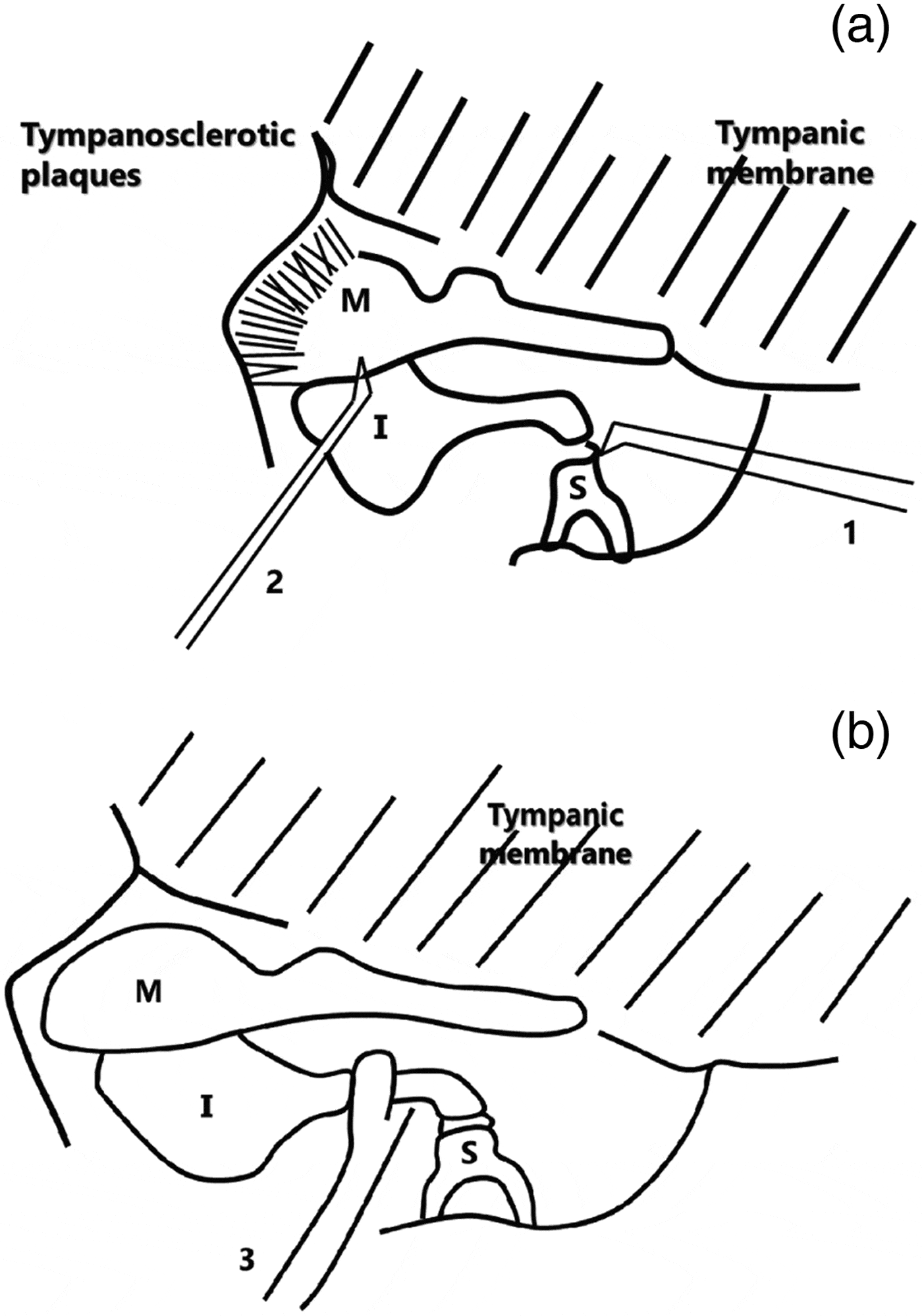 Manubrio-stapedioplasty: new surgical technique for malleus and incus ...