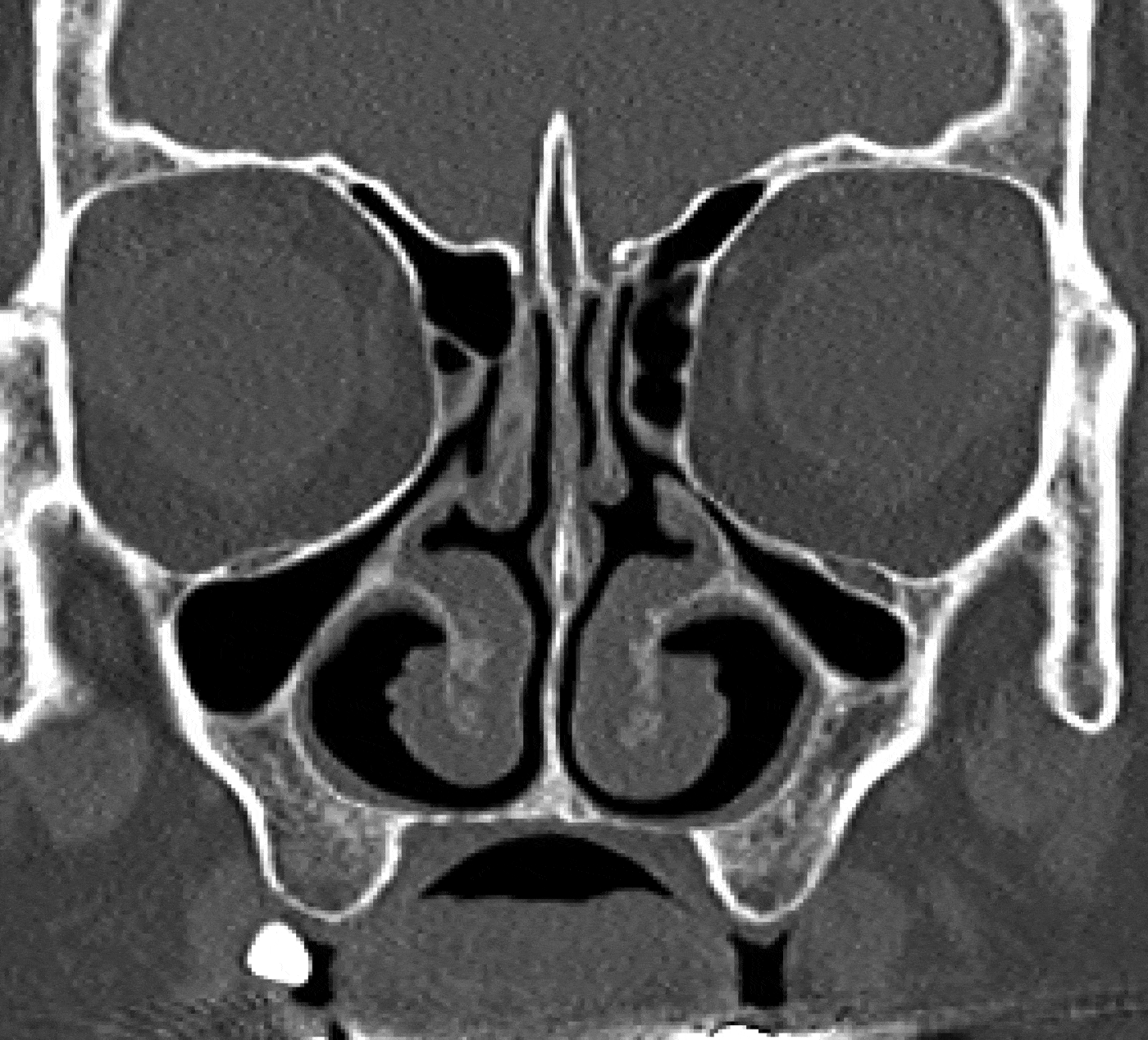 The role of the uncinate process in sinusitis aetiology: isolated ...