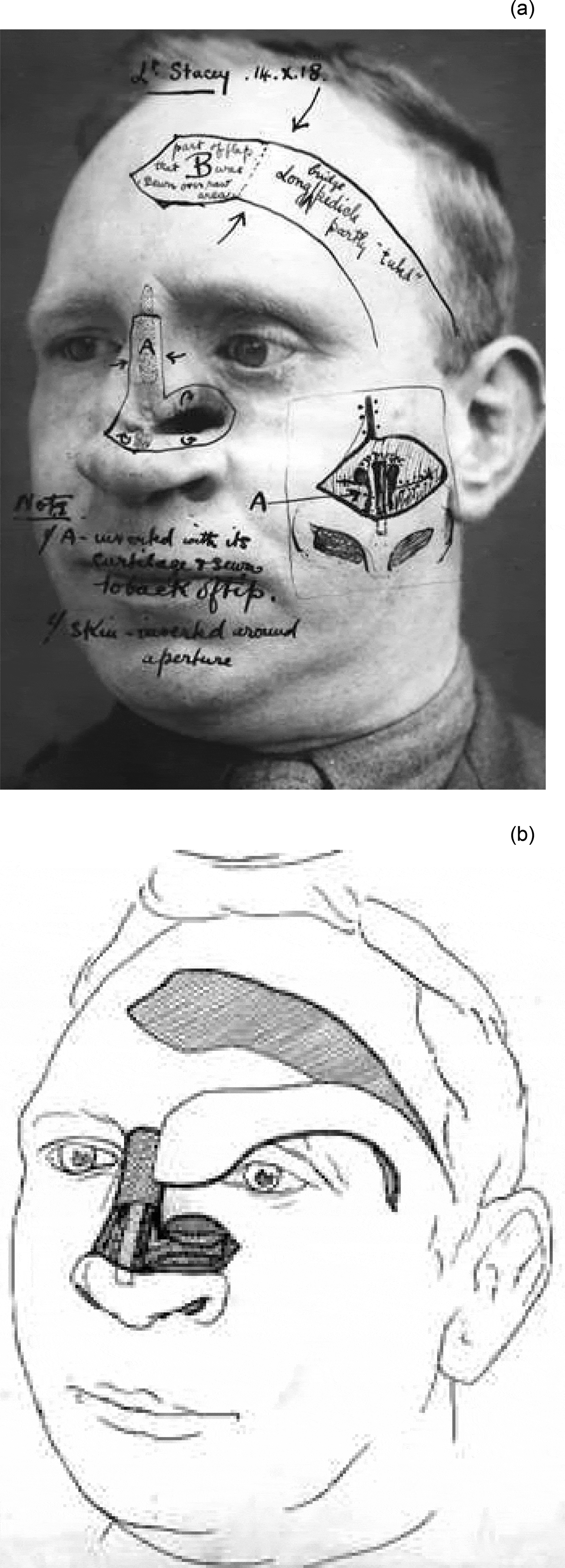 Sir Harold Delf Gillies, the otolaryngologist and father of modern ...