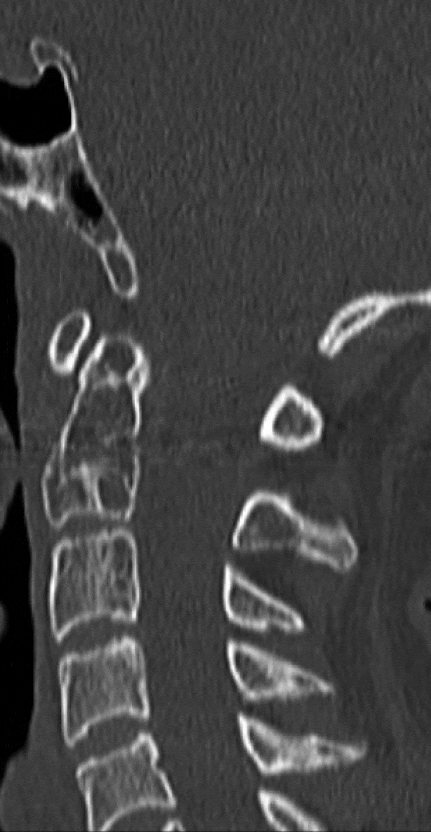 Hyperpneumatisation of the craniocervical bones: an emerging ...