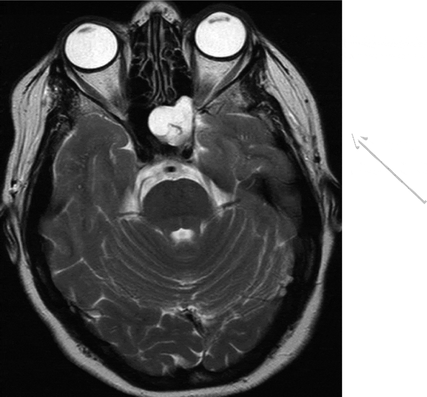 Unusual presentation of an asymptomatic pseudomeningocele within the ...