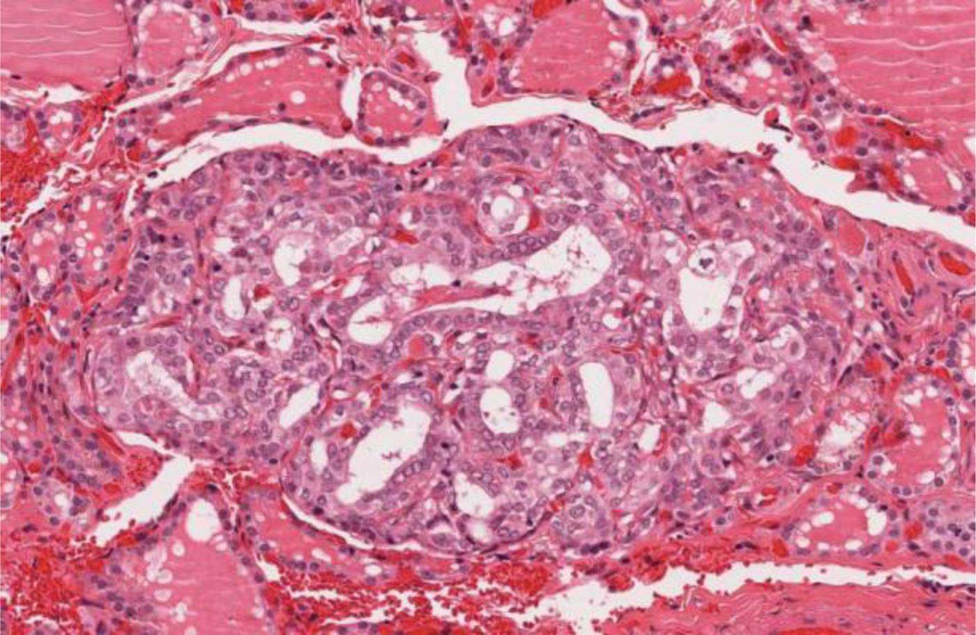 Papillary thyroid carcinoma in a lateral neck cyst: primary of ectopic ...