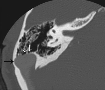 Sigmoid sinus dehiscence resurfacing as treatment for pulsatile ...