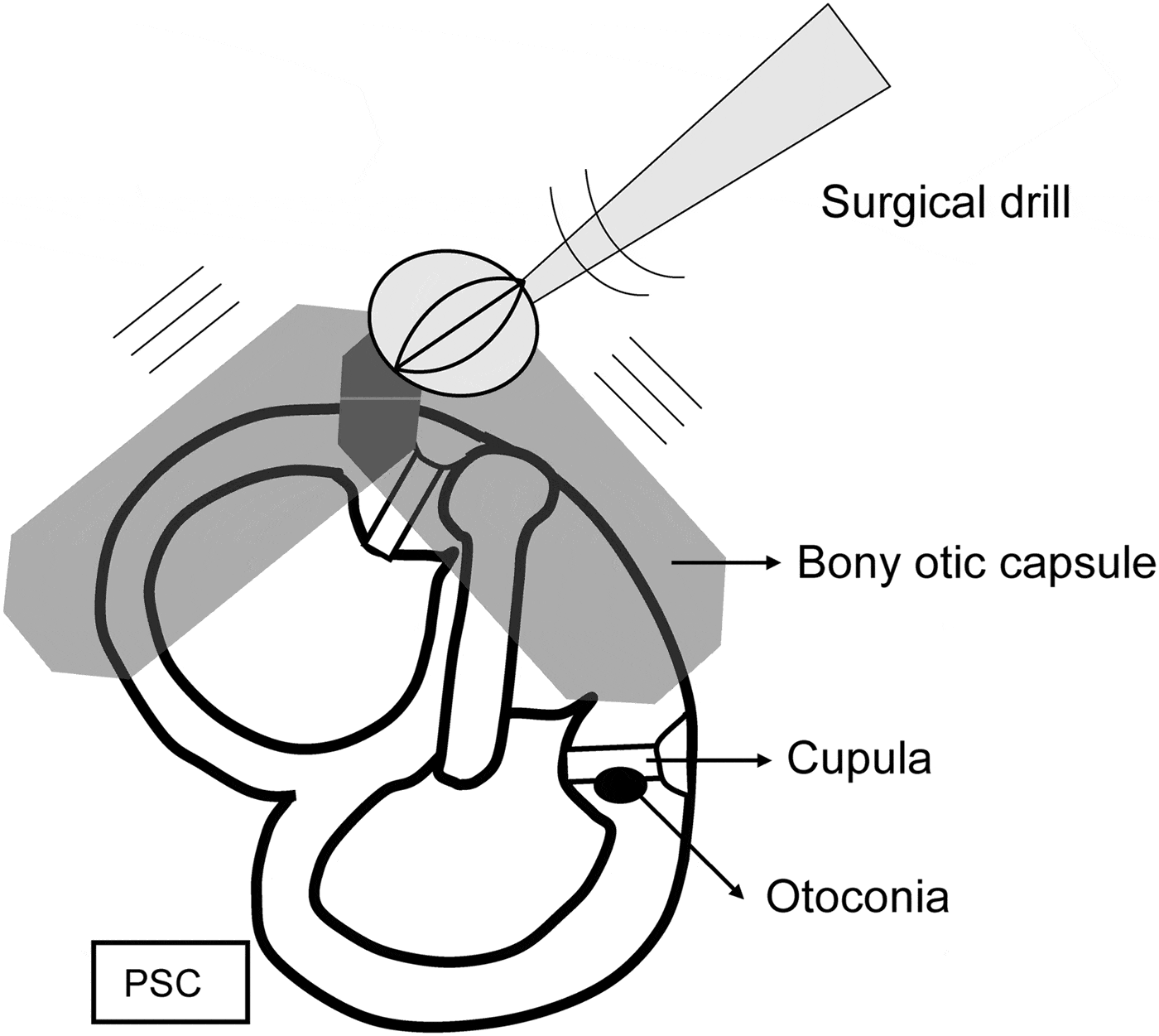 Efficacy of physical therapy for intractable cupulolithiasis in an ...