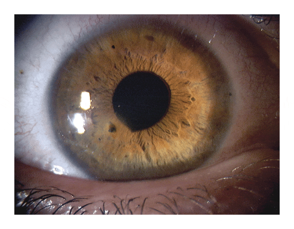 Blast Eye Injuries: A Review for First Responders | Disaster Medicine ...