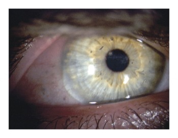 Blast Eye Injuries: A Review for First Responders | Disaster Medicine ...