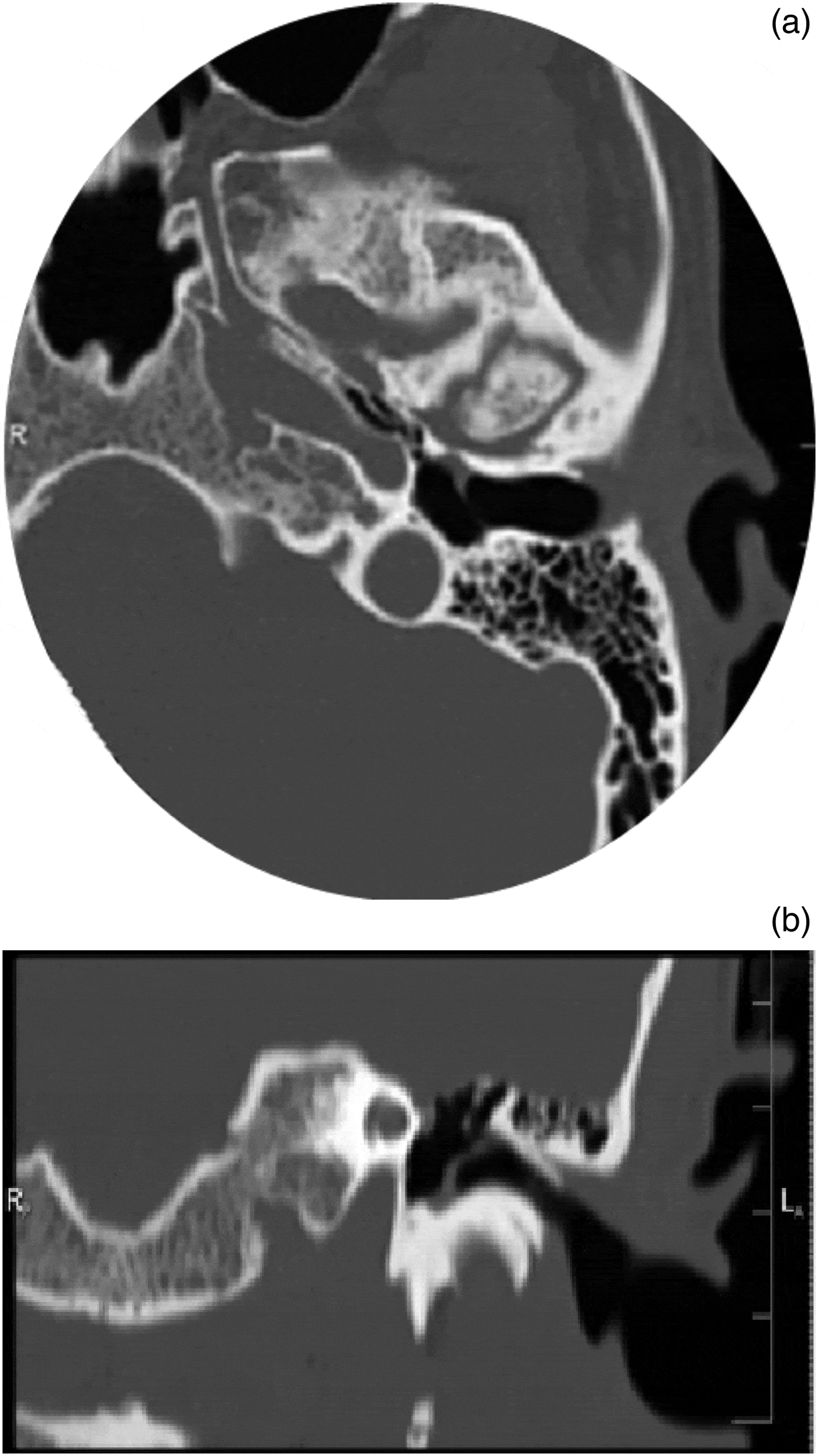 Inflammatory cast of the tympanic membrane after acute otitis media ...