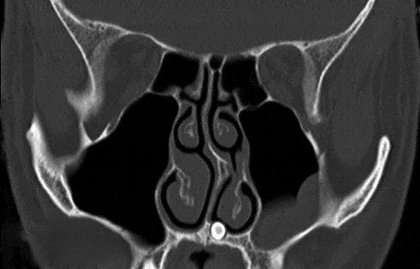 ‘Intranasal toothache’: case report | The Journal of Laryngology ...
