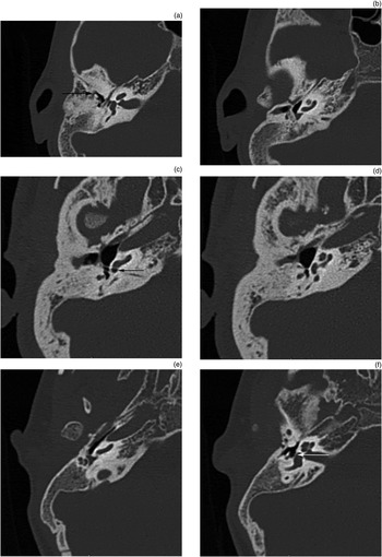 Application of the Vibrant Soundbridge middle-ear implant for aural ...