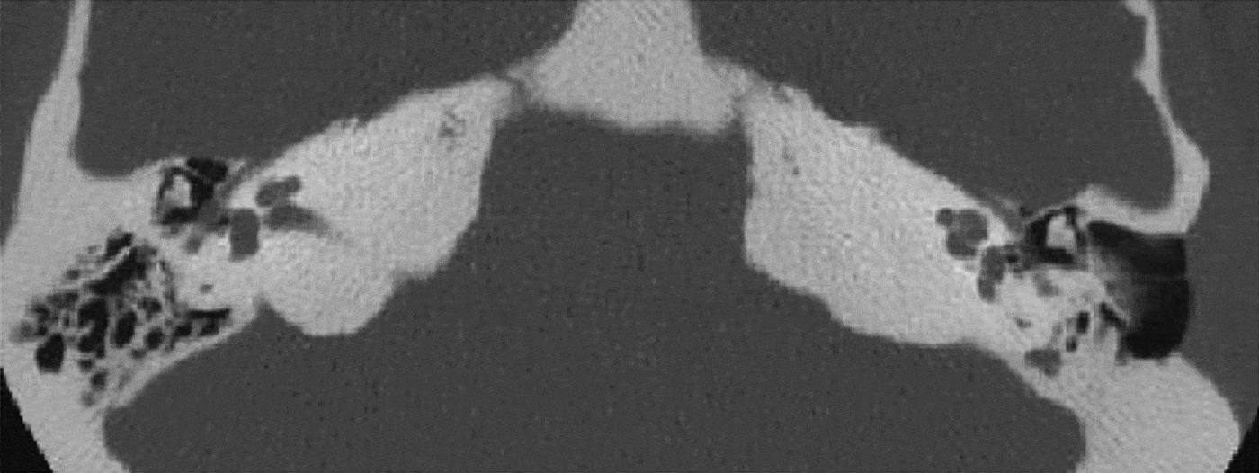 Computed tomography features of luetic osteitis (otosyphilis) of the ...