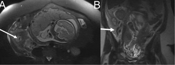 APPENDICITIS IN PREGNANCY | Fetal and Maternal Medicine Review ...