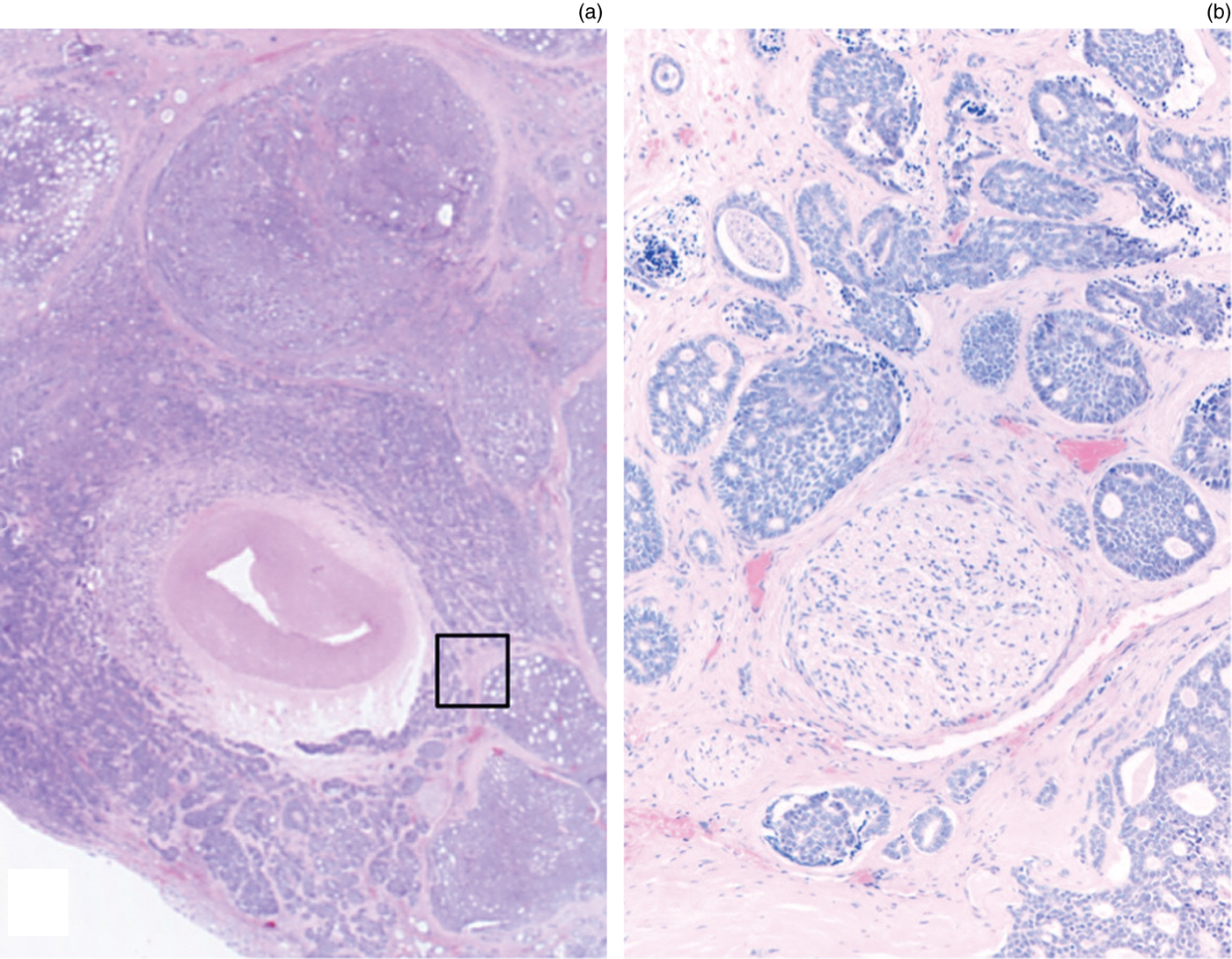 First bite syndrome as presenting symptom of parapharyngeal adenoid ...