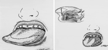 Anterior tongue reduction surgery for paediatric macroglossia | The ...