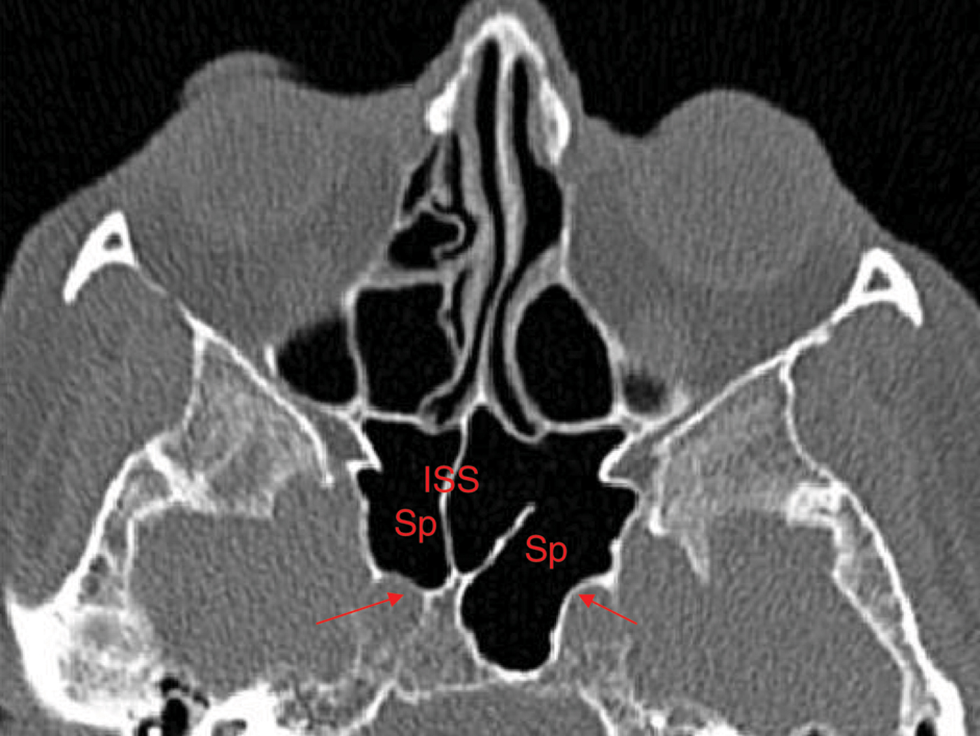 Paranasal sinus computed tomography anatomy: a surgeon's perspective ...