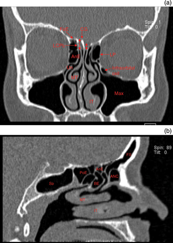 Paranasal sinus computed tomography anatomy: a surgeon's perspective ...