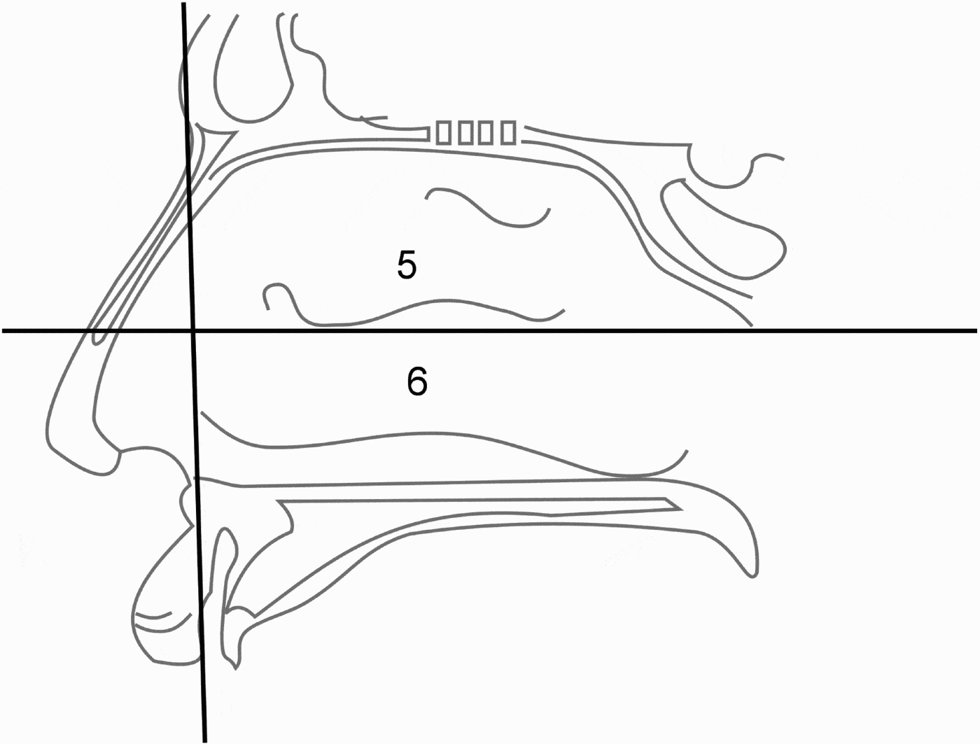 Epistaxis: prospective evaluation of bleeding site and its impact on ...