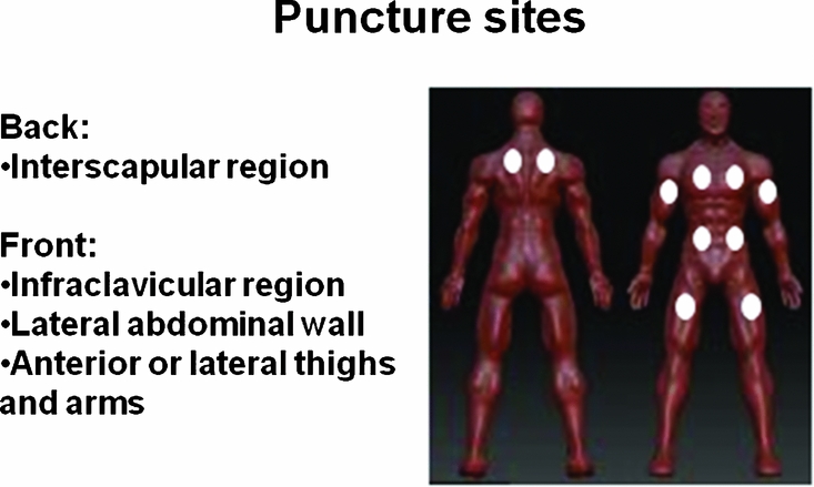 Subcutaneous hydration by hypodermoclysis | Reviews in Clinical ...