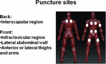 Subcutaneous hydration by hypodermoclysis | Reviews in Clinical ...