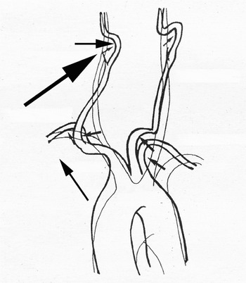 Tortuous internal carotid artery presenting as a pharyngeal mass | The ...