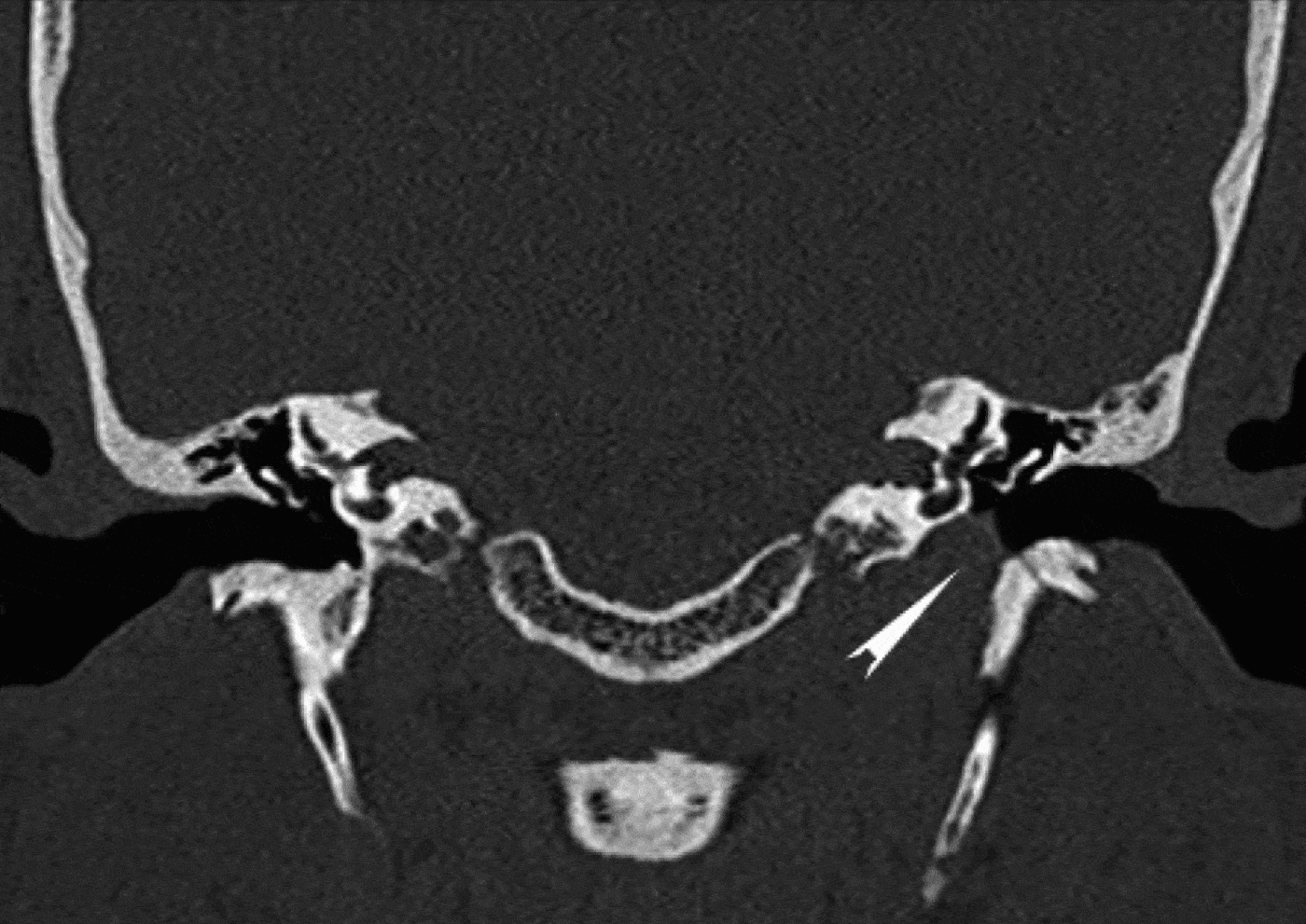 Beware the silent presentation of a high and dehiscent jugular bulb in ...