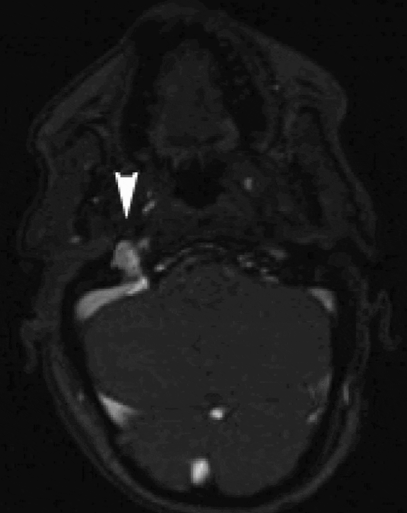 Beware the silent presentation of a high and dehiscent jugular bulb in ...