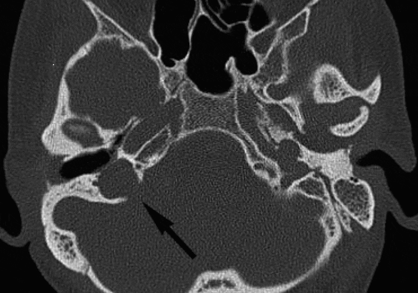 Beware the silent presentation of a high and dehiscent jugular bulb in ...