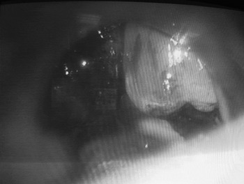 Vocal fold paralysis: role of bilateral transverse cordotomy | The ...