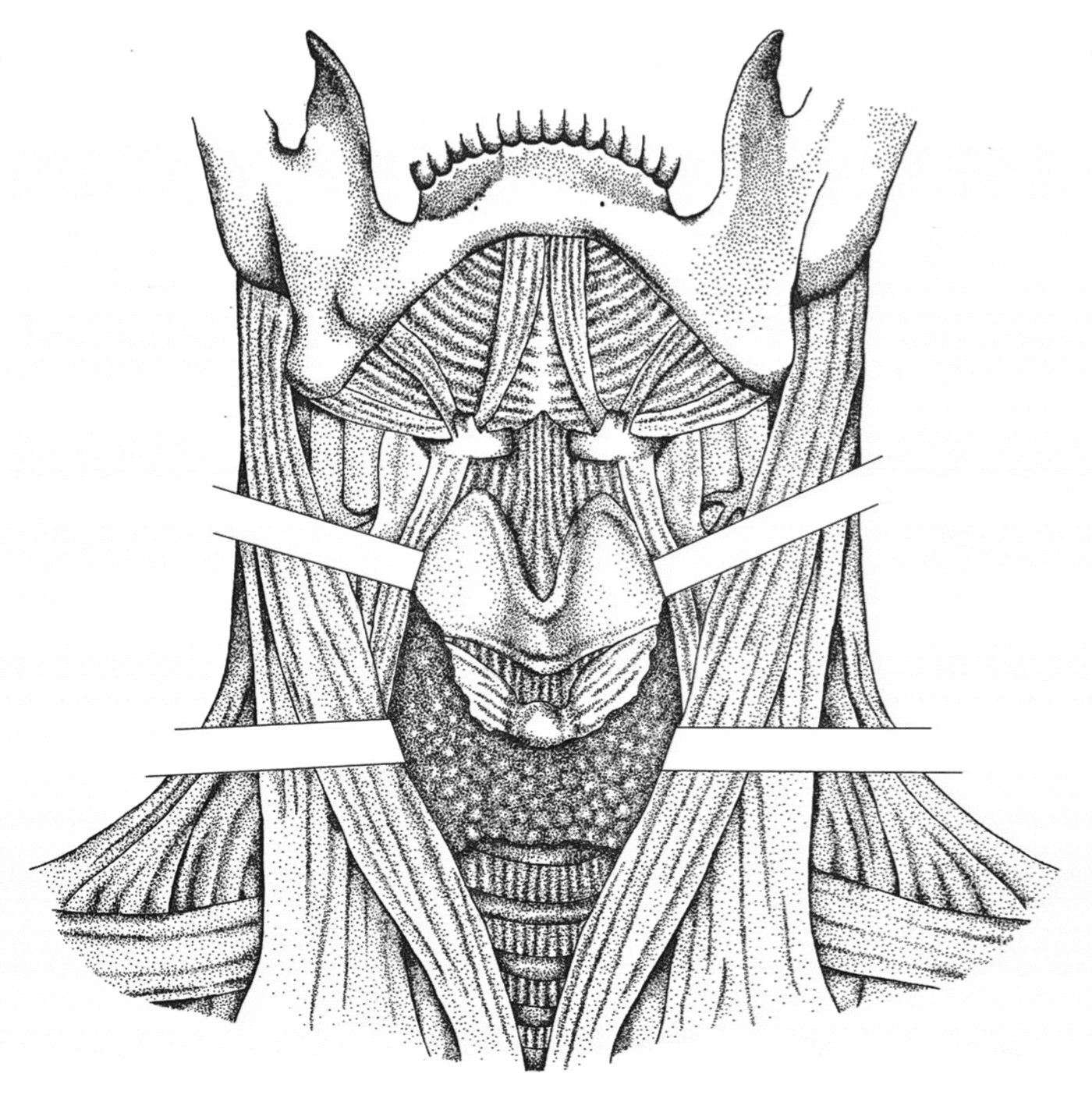 Wide anterior neck dissection for management of recurrent thyroglossal ...